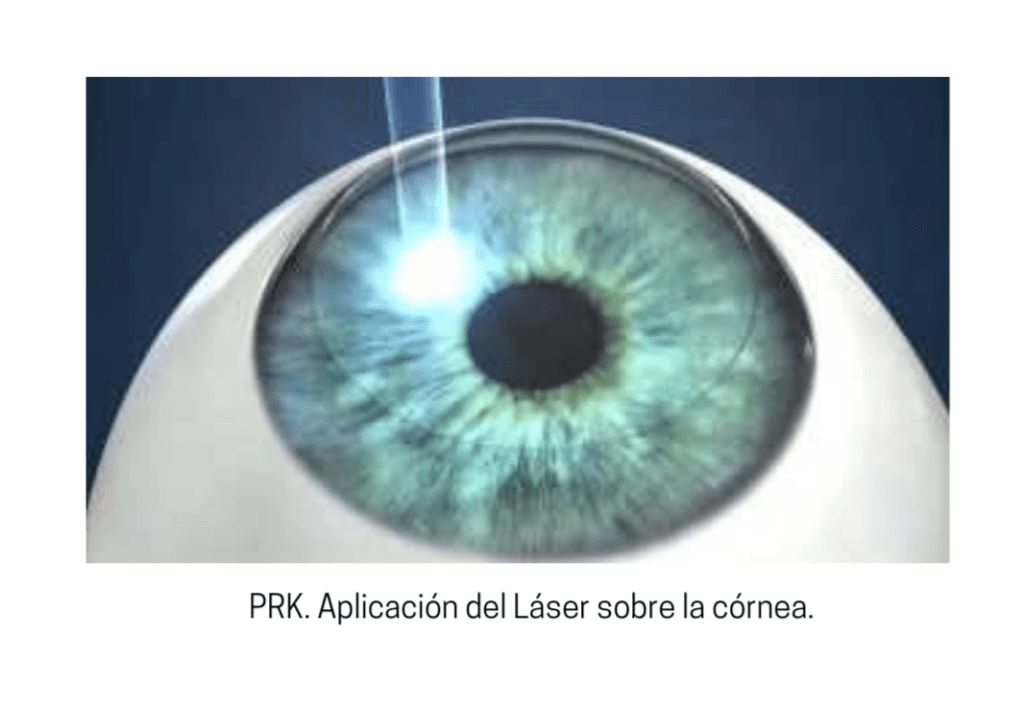 ¿Qué es la cirugía refractiva láser? - Clínica Oftalmológica ...